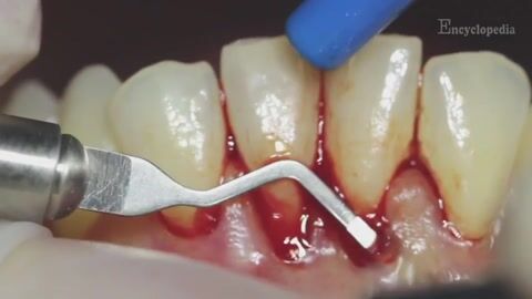 Double Lateral Sliding Bridge Flap Technique | Encyclopedia MDPI