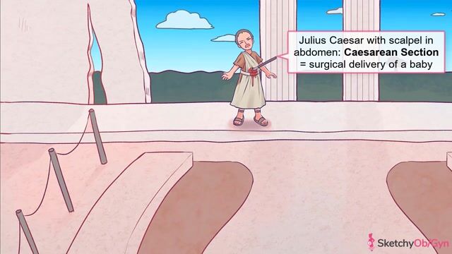 Caesarean Sections / Indications and Complications - Free Sketchy ...