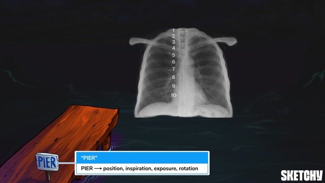 Chest X-Ray Interpretation - Free Sketchy Medical Lesson