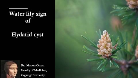 Water Lily Sign of Hydatid Cyst | Encyclopedia MDPI