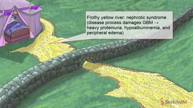 Nephrotic Syndrome SOAP - Free Sketchy Medical Lesson
