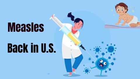 Measles is Back Across the U.S.! Are You Protected? | Encyclopedia MDPI