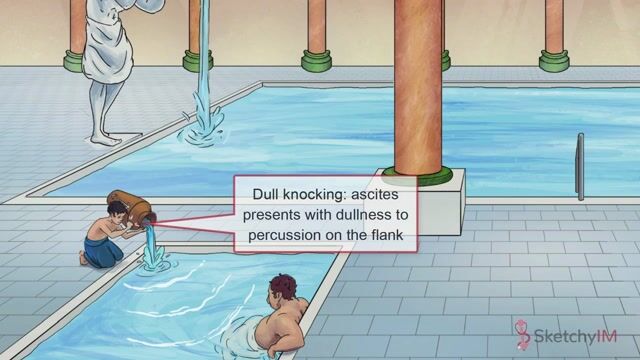 Ascites DDx - Free Sketchy Medical Lesson