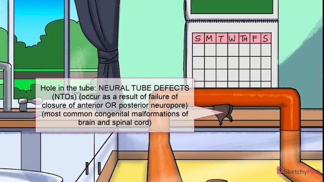 Neural Tube Defects, Holoprosencephaly, Chiari Malformation ...